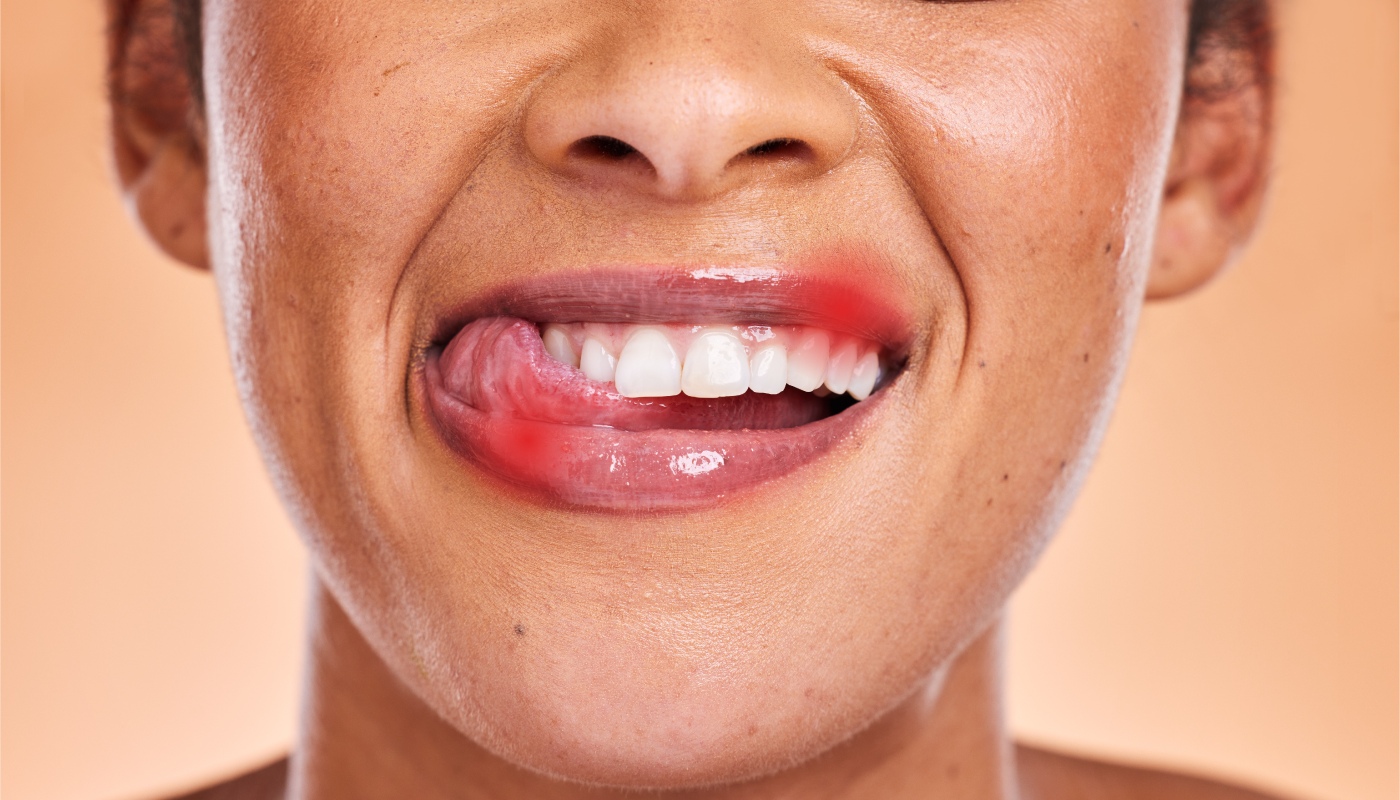 The One-Use Solution to Mouth Ulcer Pain: ORALMEDIC vs. Numbing Gels